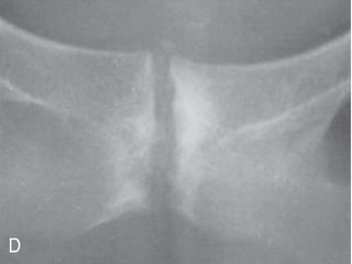 Calcium Pyrophosphate Deposition (CPPD) overview.ppt