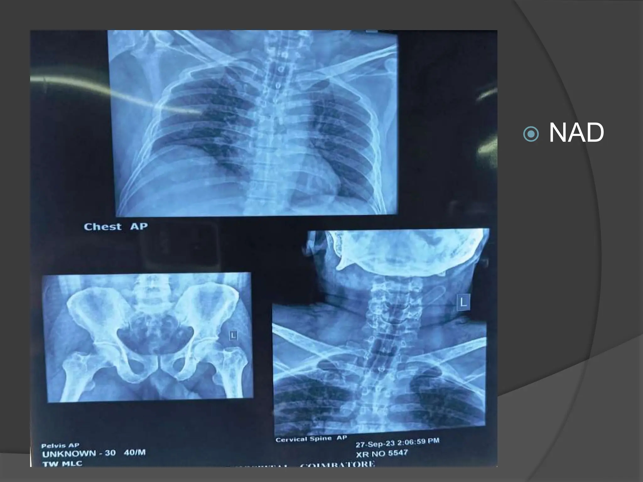 clinical polytrauma case presentation .pptx | Lung and Respiratory ...
