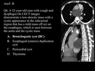 POSTERIOR MEDIASTINAL MASS | PPTX