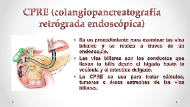 CPRE (ColangioPancreatografía Retrógrada Endoscópica)