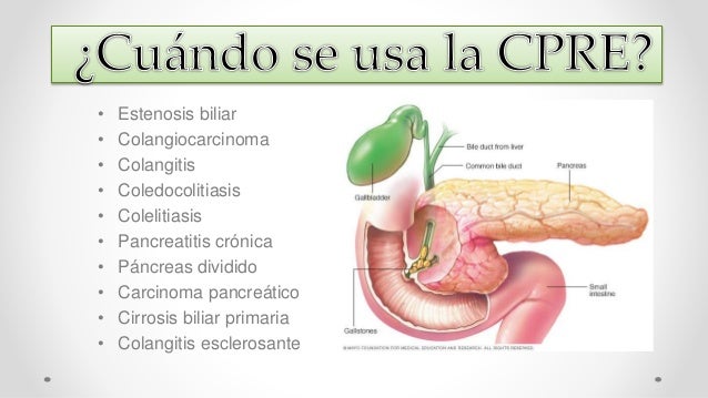 CPRE (ColangioPancreatografía Retrógrada Endoscópica)