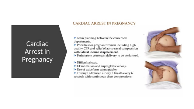 cardiopulmonary resuscitation and pregnancy | PPTX | First Aid | Injuries