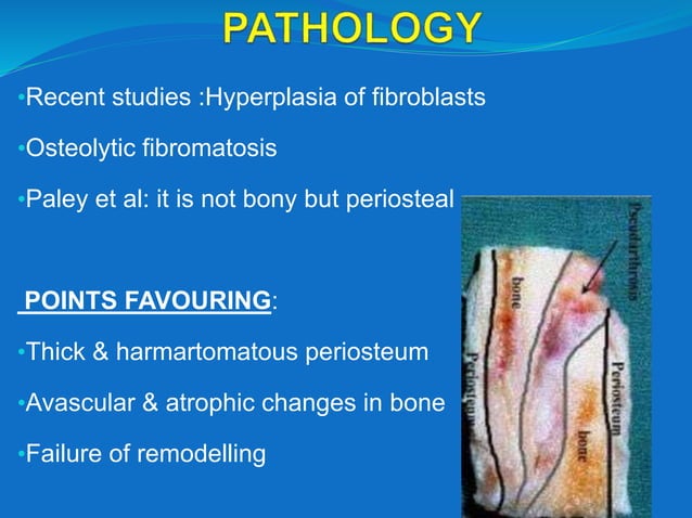 Congenital pseudoarthrosis of tibia | PPTX