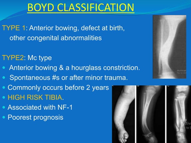 Congenital pseudoarthrosis of tibia | PPTX