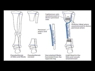 Congenital pseudoarthrosis the of tibia | PPTX