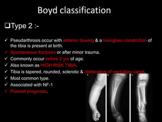 Congenital pseudoarthrosis tibia | PPTX