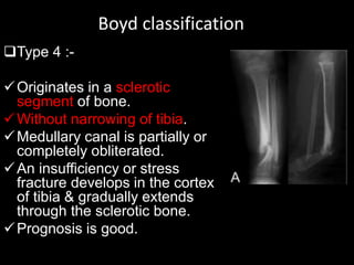 Congenital pseudoarthrosis tibia | PPTX