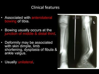 Tibial Pseudarthrosis