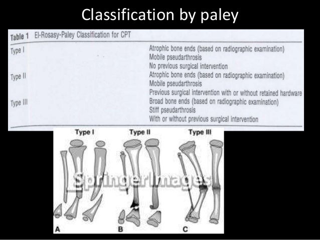 Congenital pseudoarthrosis tibia