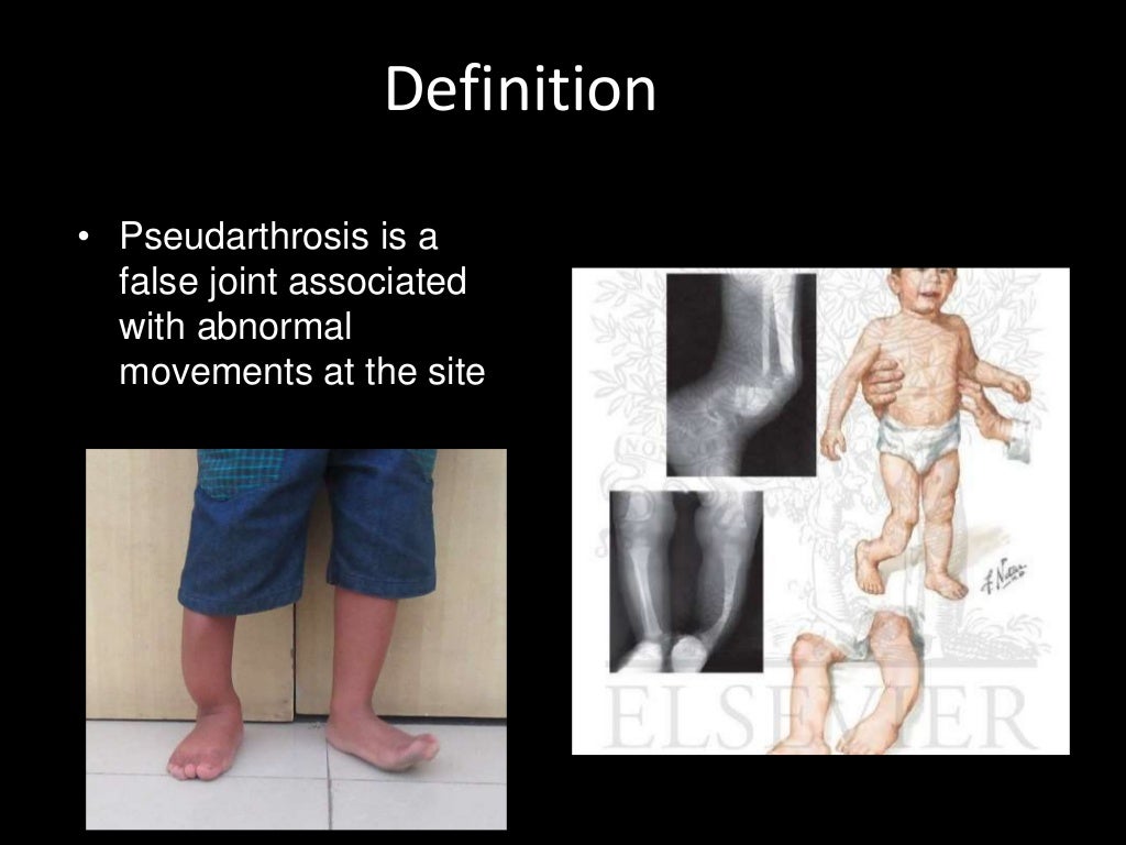 Congenital pseudoarthrosis tibia
