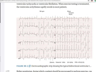 Catecholaminergic Polymorphic VT | PPTX