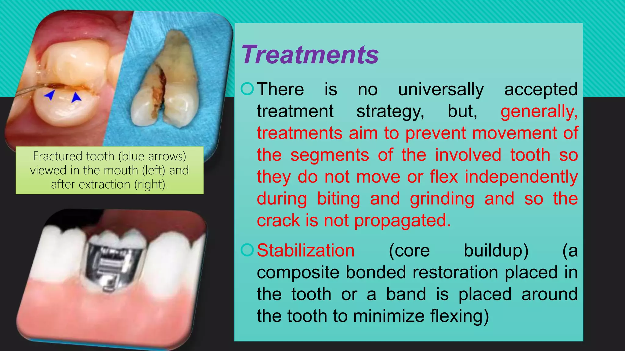 Cracked tooth syndrom | PPTX