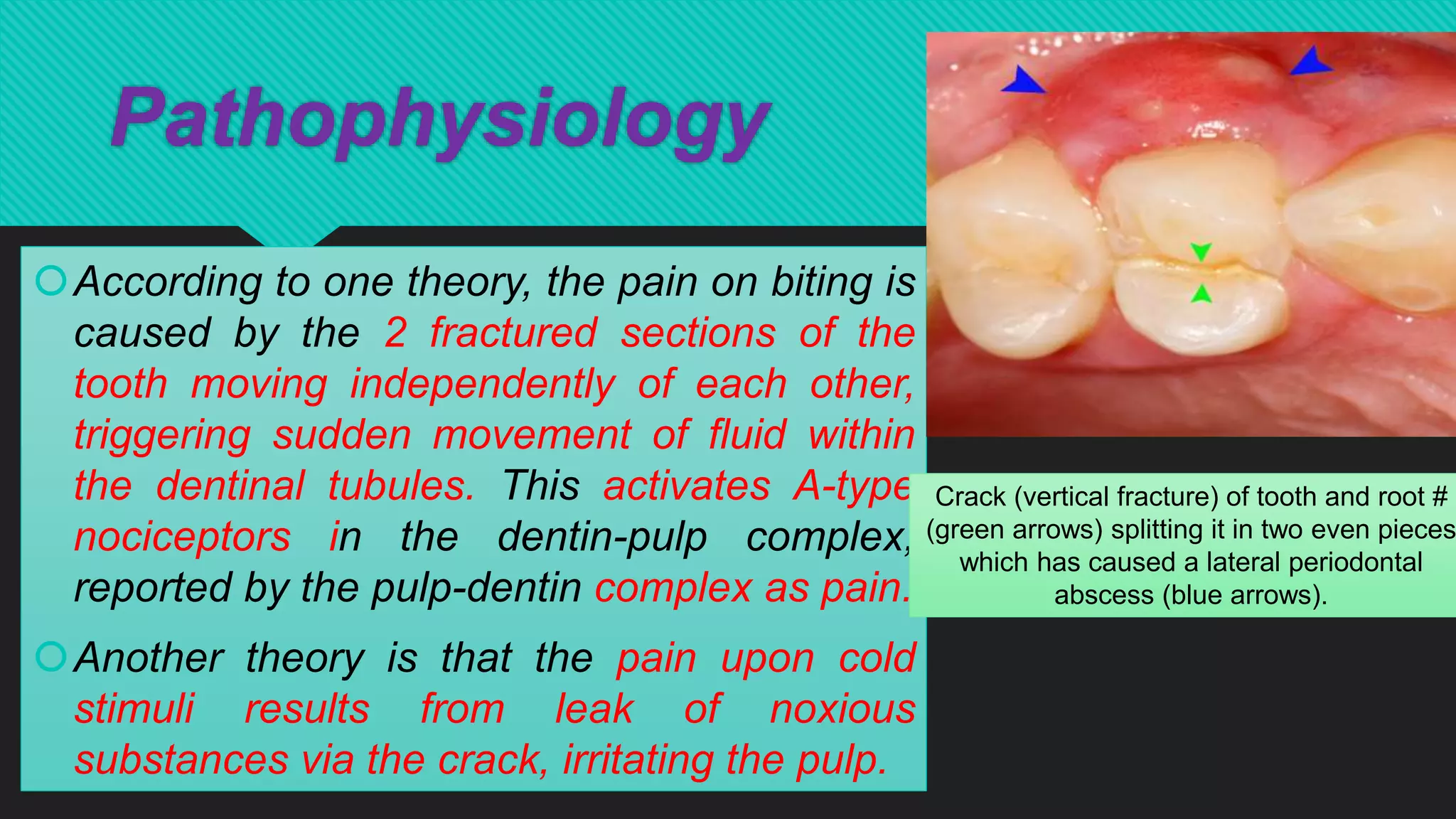 Cracked tooth syndrom | PPTX