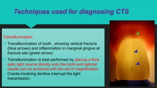 Cracked tooth syndrom | PPTX