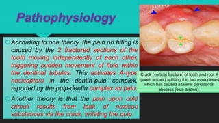 Cracked tooth syndrom | PPTX