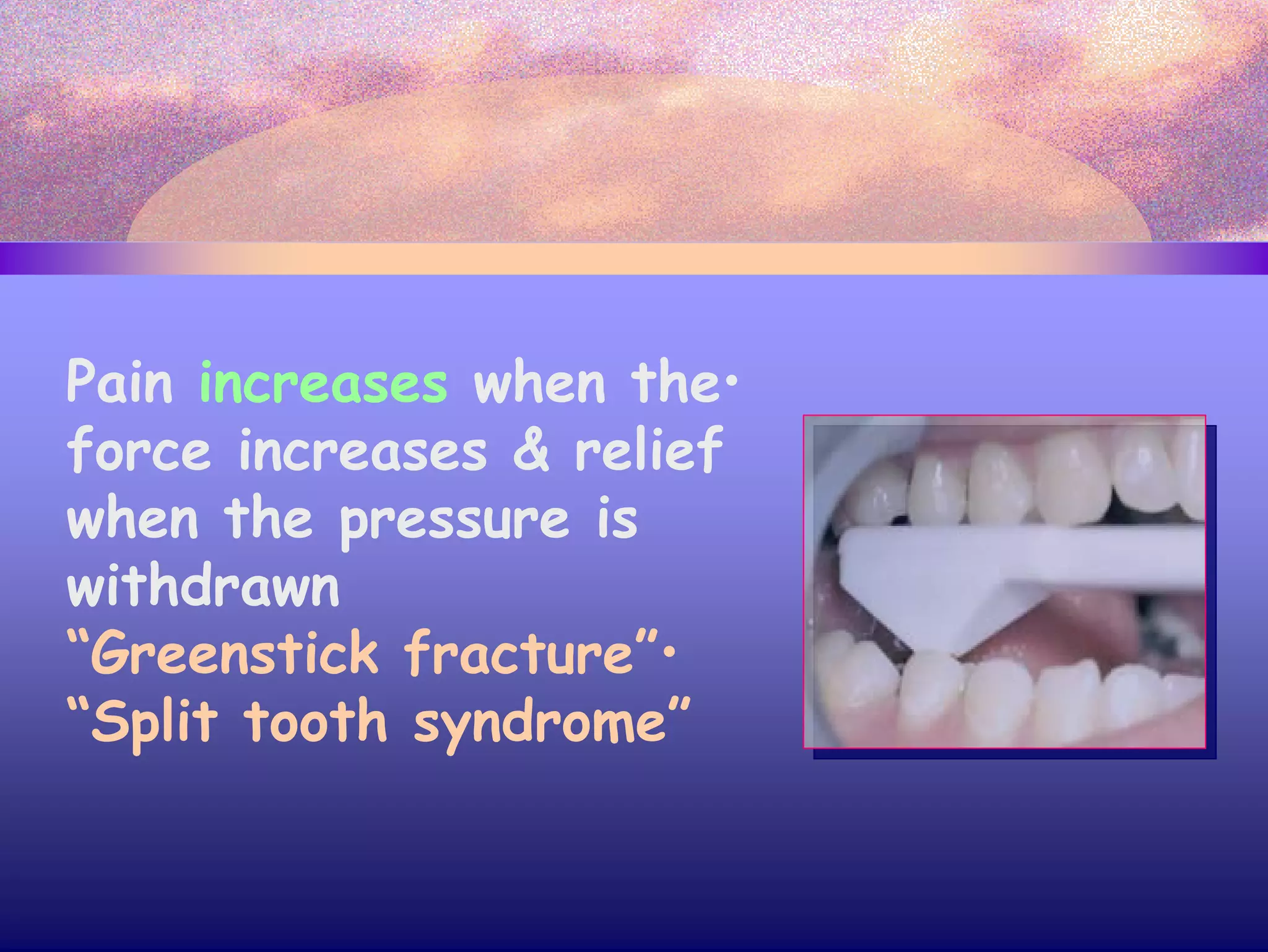 Cracked Tooth Syndrome.pdf