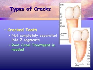 Cracked Tooth Syndrome.pdf