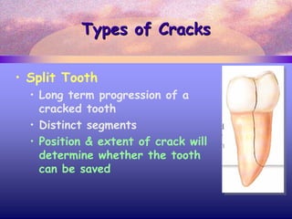 Cracked Tooth Syndrome.pdf