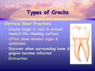 Cracked Tooth Syndrome.pdf
