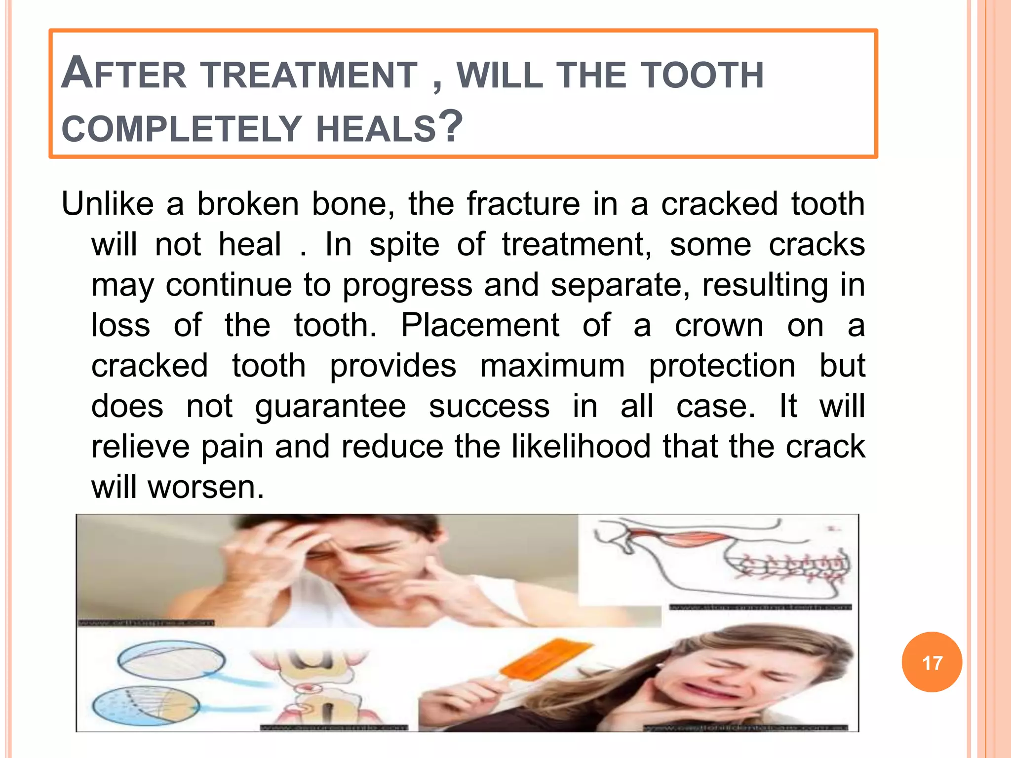 Cracked tooth syndrome | PPTX