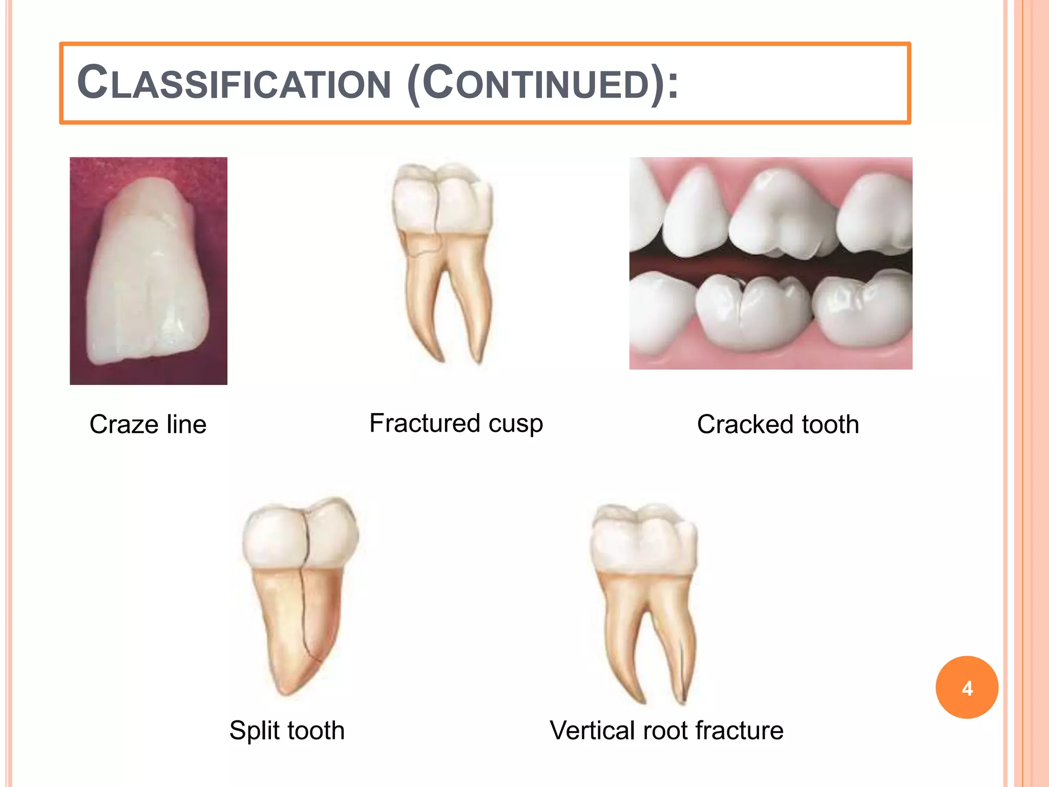 Cracked tooth syndrome | PPTX