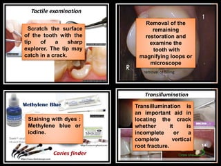 Cracked tooth syndrome | PPTX