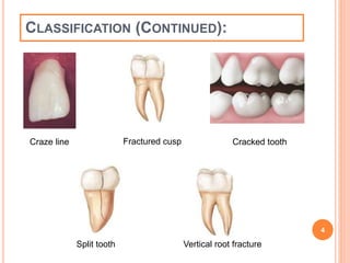 Cracked tooth syndrome | PPTX