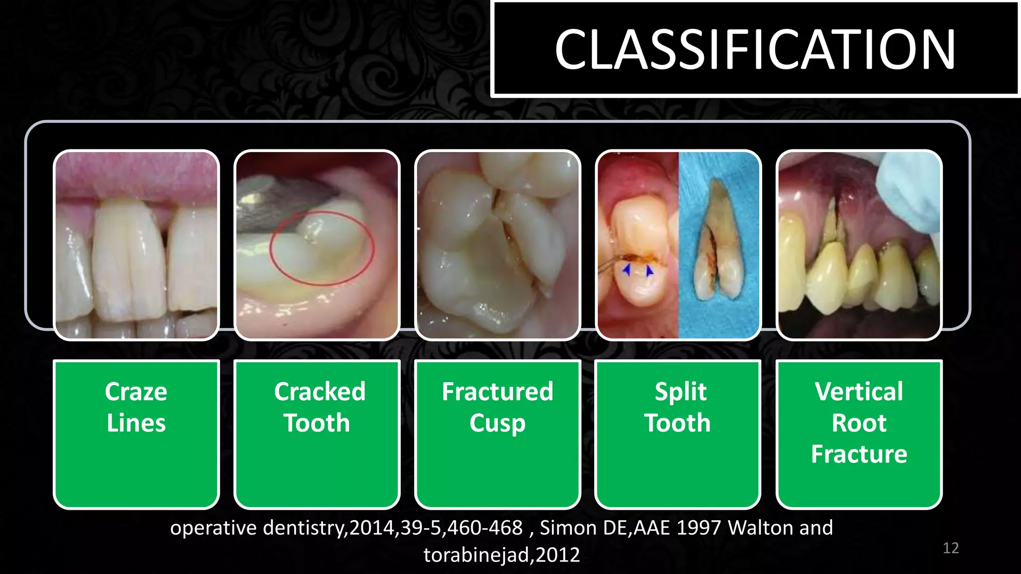 Cracked tooth syndrome in an | PPTX