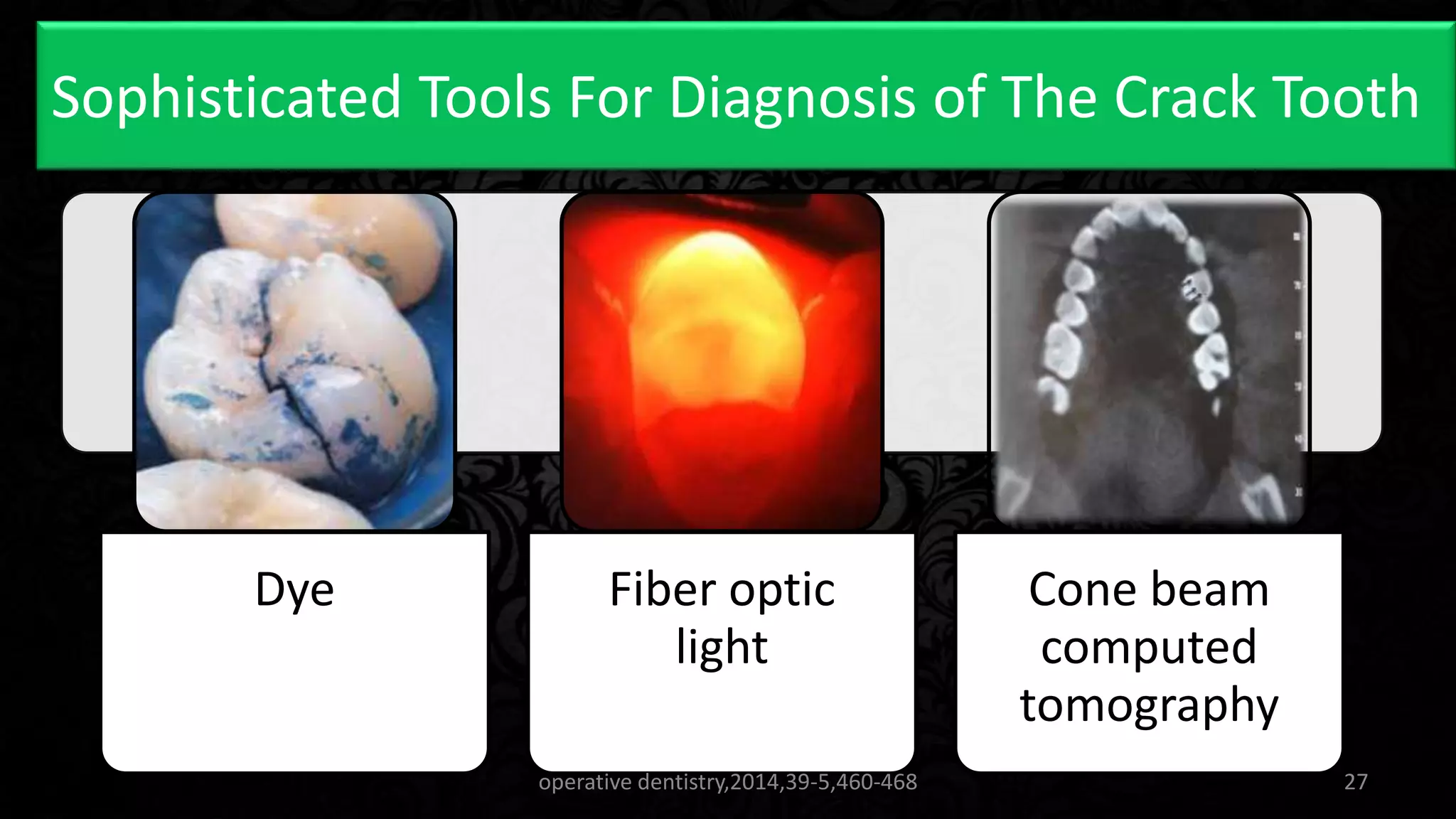 Cracked tooth syndrome in an | PPTX