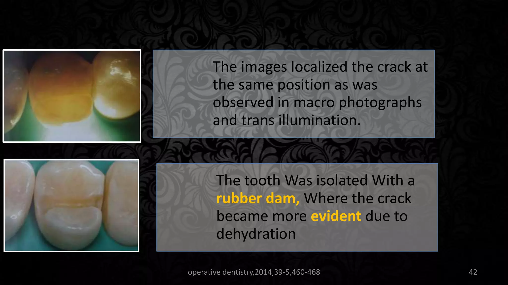 Cracked tooth syndrome in an | PPTX