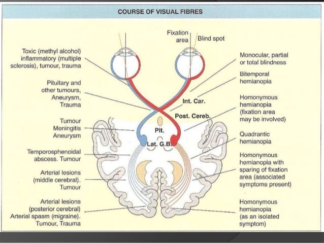 Small Optic Nerve