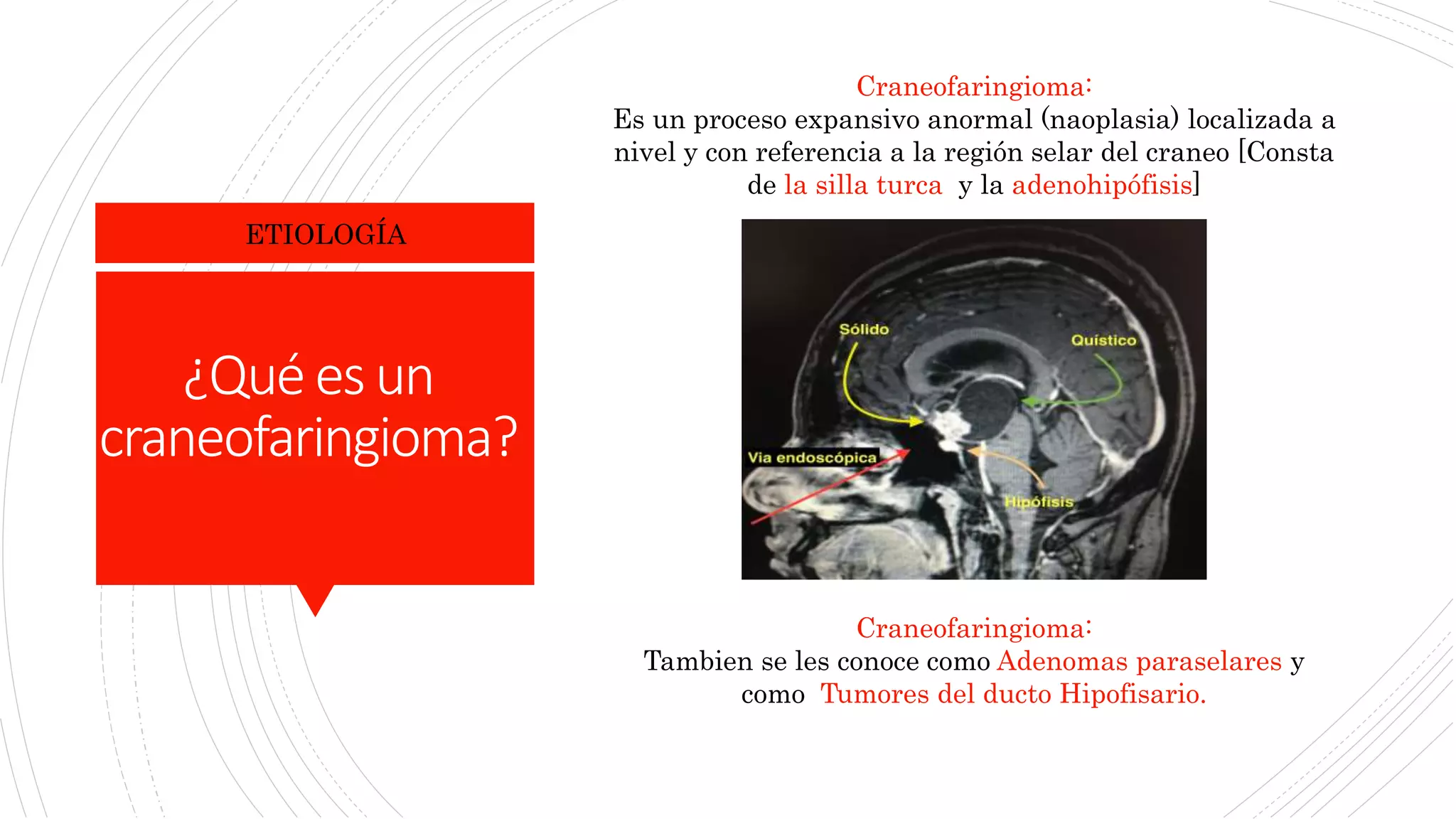 Craneofaringiomas | PPT