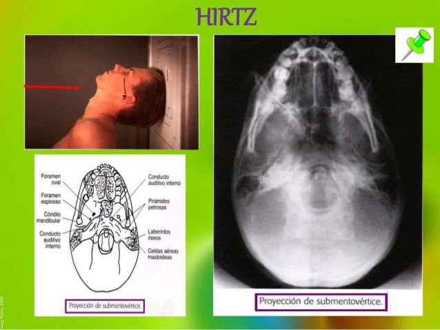 anatomia radiologica de craneo