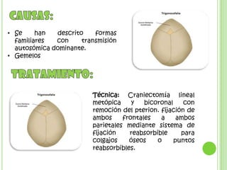 Craneosinostosis | PPTX