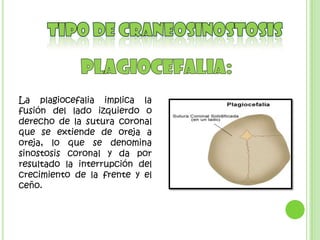 Craneosinostosis | PPTX