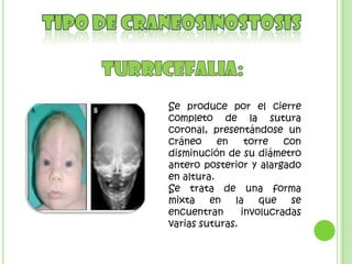 Craneosinostosis | PPTX