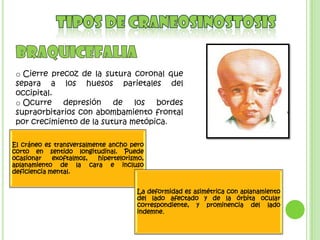 Craneosinostosis | PPTX