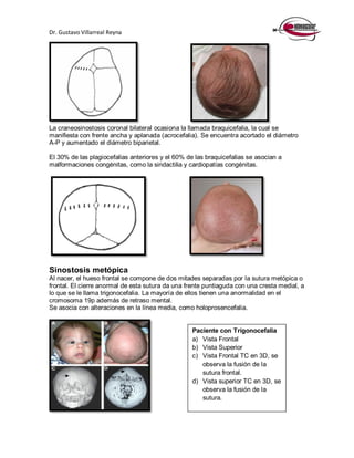 Craneosinostosis | PDF