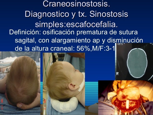 Craneosinostosis defecto craneo facial