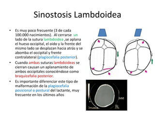 Craneosinostosis No Sindromicas | PPT