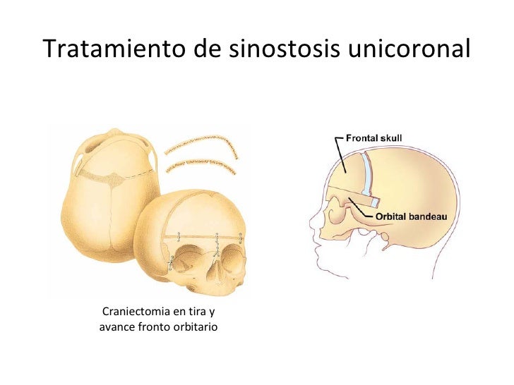 Craneosinostosis No Sindromicas