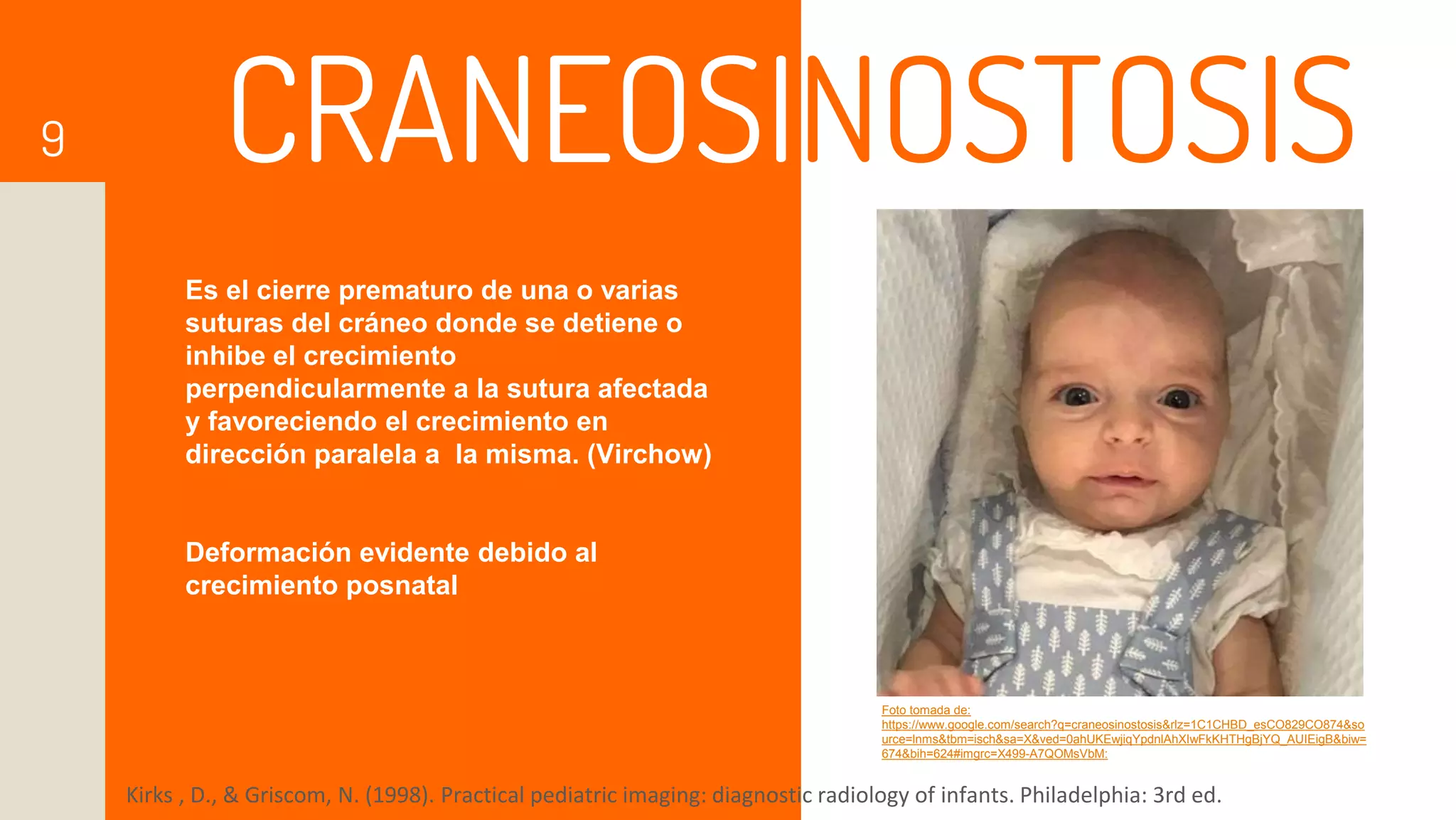 Craneosinostosis y displasia cleidocraneal | PPTX
