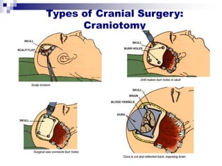 Head-intracranial-surgery-care-nursing.ppt
