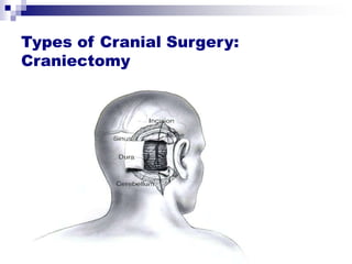 Head-intracranial-surgery-care-nursing.ppt