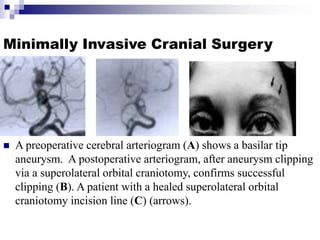 Head-intracranial-surgery-care-nursing.ppt