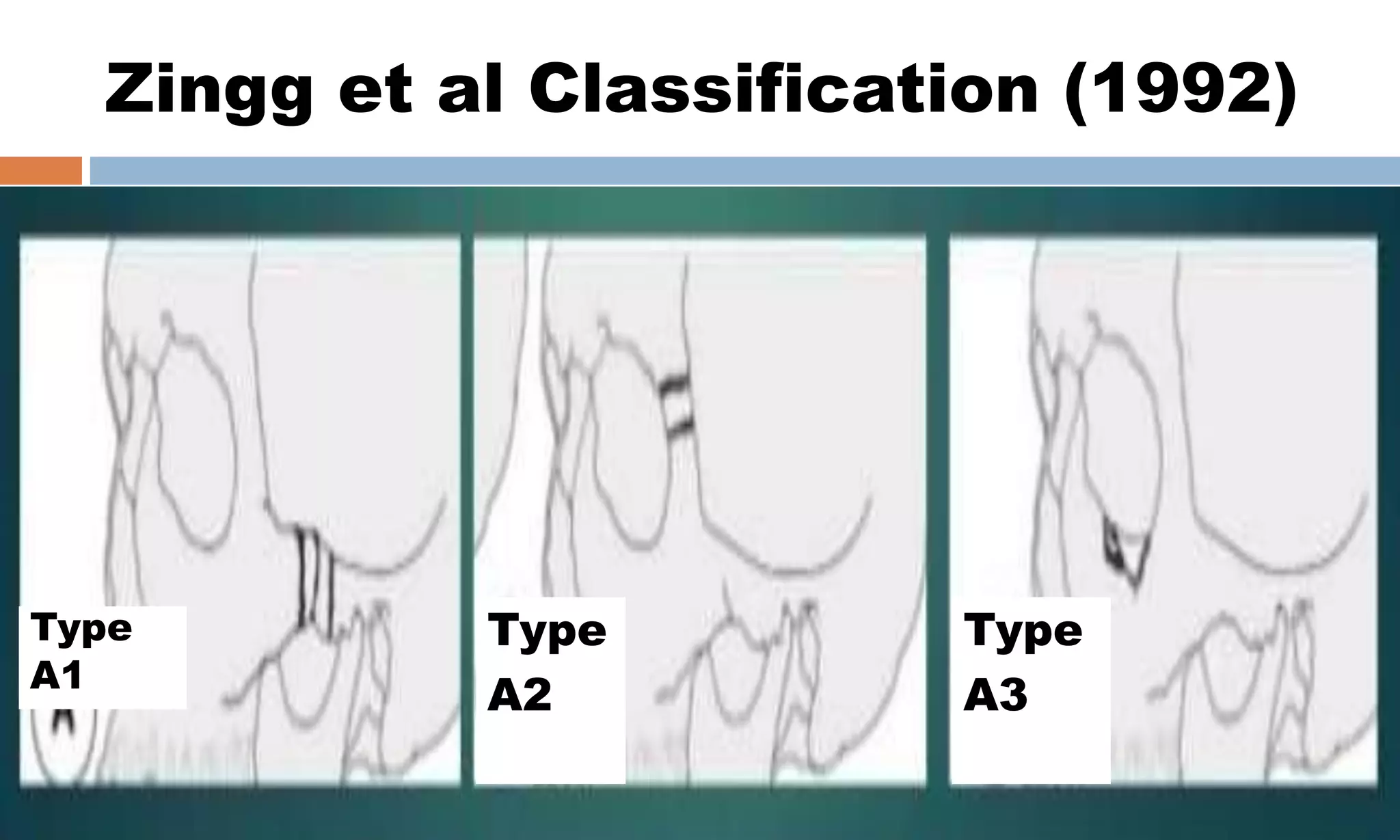 Cranial and facial fractures | PPTX