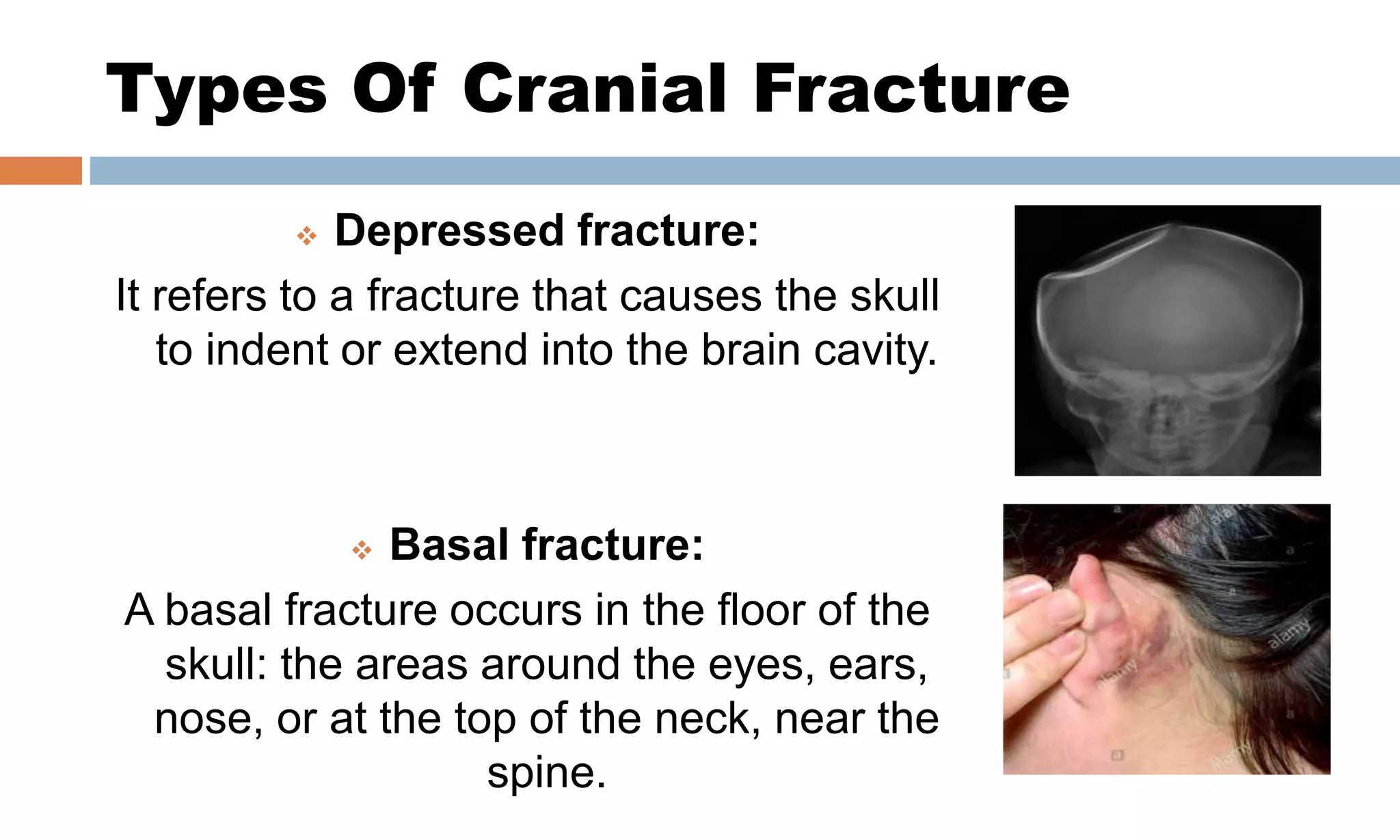 Cranial and facial fractures | PPTX