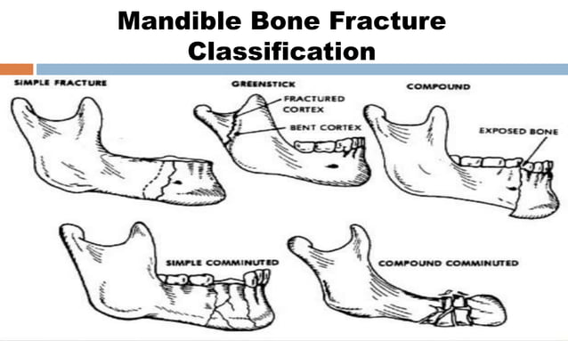 Cranial and facial fractures | PPTX
