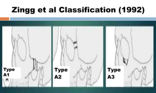 Cranial and facial fractures | PPTX