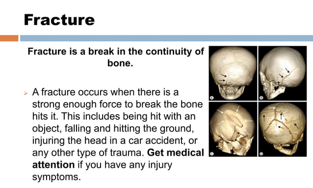 Cranial and facial fractures | PPTX